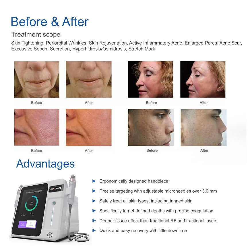 Fractional RF Micro Needle Machine | Advanced Skin Rejuvenation – COSDERMA